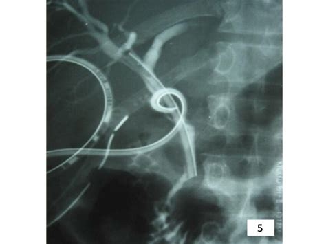 T Tube Cholangiogram 3 Weeks After Surgery Shows No Evidence Of Download Scientific Diagram