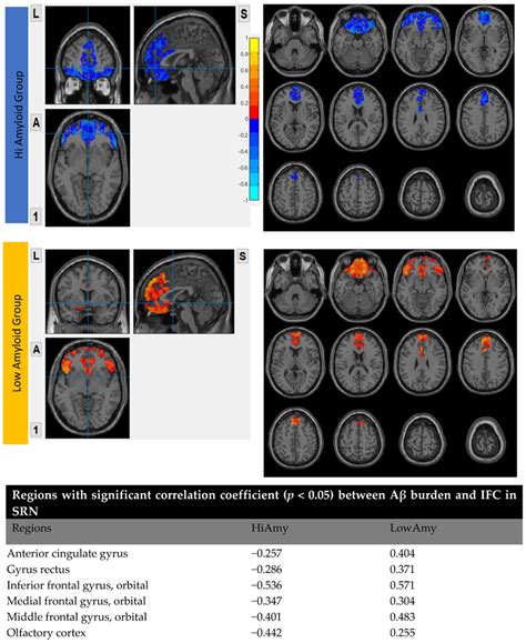 Correlation Between Aβ Burden And Ifc In Srn Download Scientific Diagram