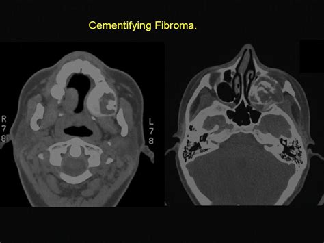 Ossifying Fibroma Maxilla Juvenile Trabecular Ossifying Fibroma
