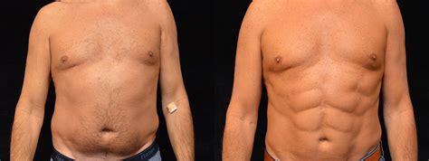 Ab Etching 6 Pack Abs Before And After Photos Baltimore Plastic