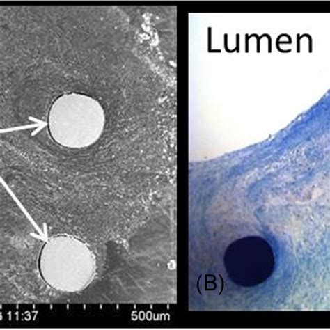 Vessel Lumen Upper Left And Vascular Wall Containing The Stent Struts