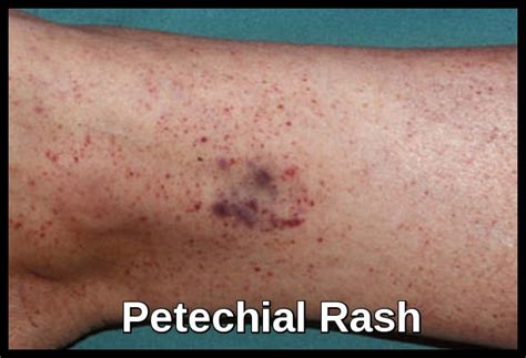 Thrombocytopenia Ask Hematologist Understand Hematology