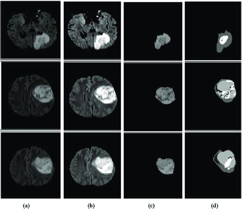 Sample Images From Brats Dataset A Original Image B Tumor