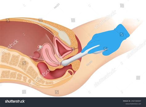 Pelvis With Transvaginal Ultrasound Transvaginal Ultrasound Stock