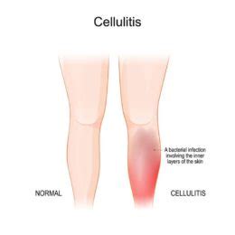 Cellulitis The Vascular And Endovascular Clinic