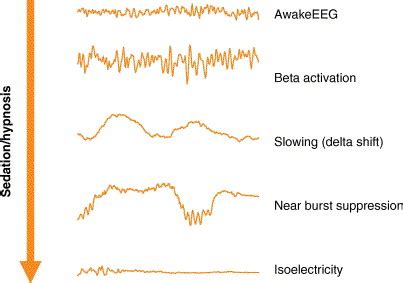 EEG Approaches To Measuring Depth Of Anesthesia Sapien Labs Shaping The Future Of Mind Health
