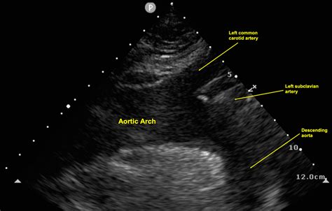 Thoracic Aortic Aneurysm Presenting As A Subacute Cough Pocus Journal