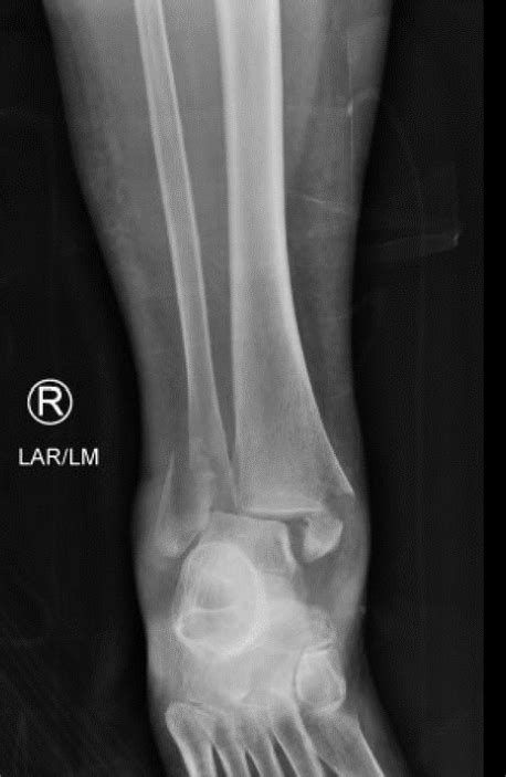 Case Report Trimalleolar Ankle Fracture Sports Medicine Review