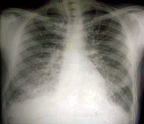 Microlithiasis Of Seminal Vesicles And Severe Oligoasthenospermia In