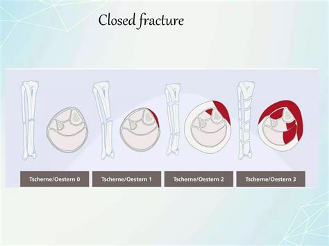 Principles Of Fractures Management Pptx