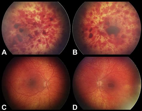Eye Bleeding Retina At Lisa Hawke Blog