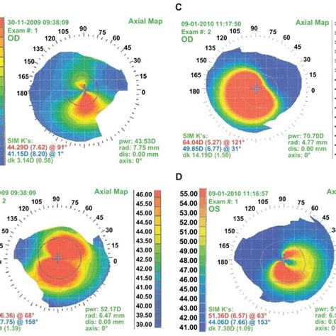 Pdf Revisiting Corneal Topography For The Diagnosis Of Keratoconus Use Of Rabinowitzs Kisa