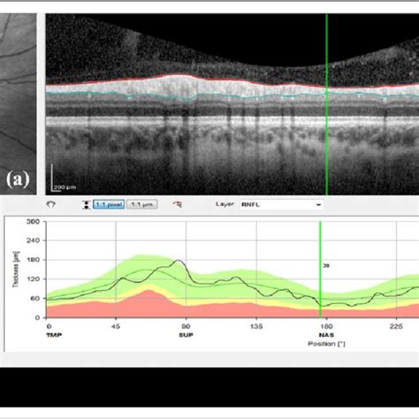 Automatic Segmentation Of The Retina For Measurement Of Retinal Layers Download Scientific