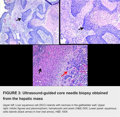 Figure 2 From Pure Squamous Cell Carcinoma Of The Gallbladder