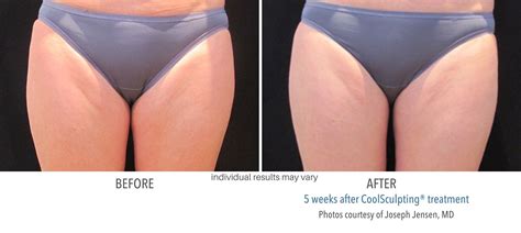 Coolsculpting Thighs Reduce Stubborn Thigh Fat