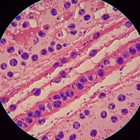 Quantum Neural Networks Reduce Bias In Colorectal Cancer Surgery Outcomes