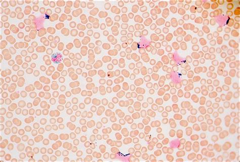 Pathology Outlines Aml With Maturation Fab Aml M2