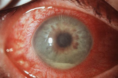 Anterior Uveitis — Medlibes Online Medical Library