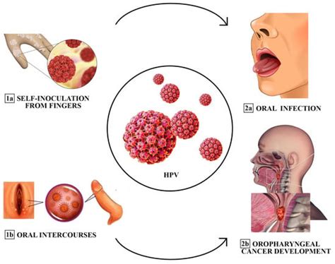 Analogies Between Hpv Behavior In Oral And Vaginal Cavity Narrative