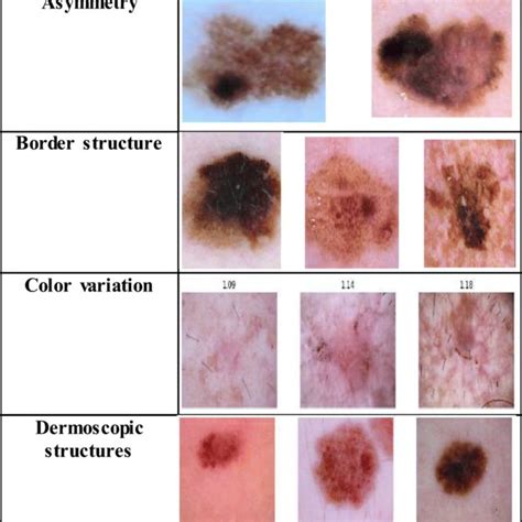 Feature Extraction Using Abcd Rule Of Dermoscopy Download Scientific Diagram