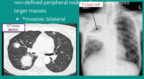 Pulmonary Fungal Infections Flashcards Quizlet
