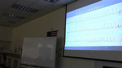 Heart Blocks And Pacemaker Rhythms Part 2 Youtube