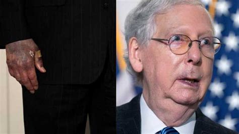 Mitch Mcconnell Says No Concerns Despite Visible Bandages And Bruises