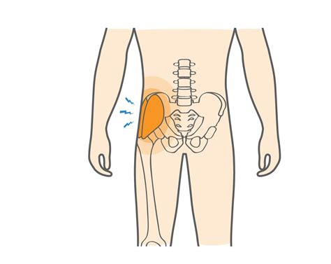 What Is Gluteal Tendonitis And The Pain It Brings Upswing Health