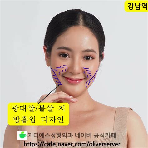 광대살 볼살 지방흡입 이중턱지방흡입 작은얼굴 만드는 방법은 지디에스성형외과 지디에스 강남역성형외과 Youtube