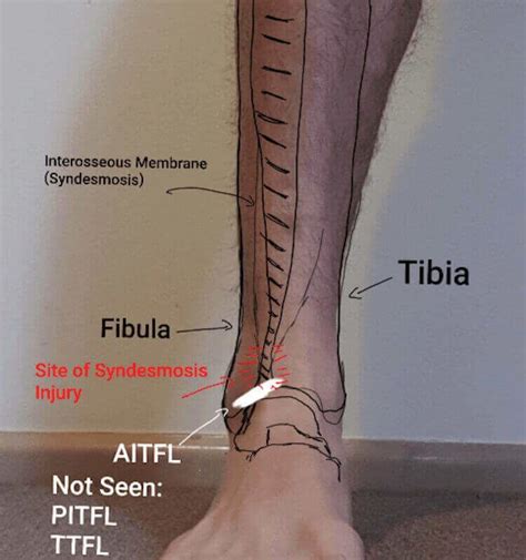 Teyder Syndesmosis Ankle Band