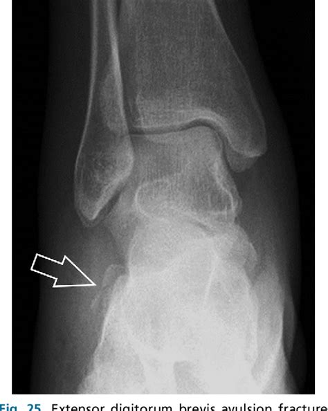 Extensor Digitorum Brevis Avulsion