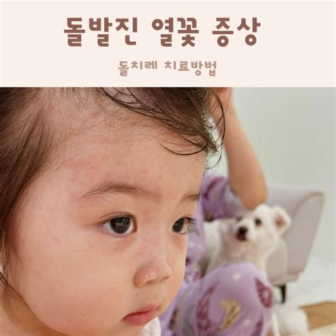 13개월 아기 돌 발진 열꽃 증상과 원인 치료방법 네이버 블로그