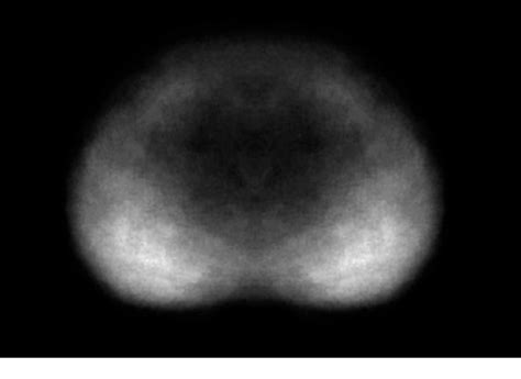 Figure 1 From Multicenter Validation Of Prostate Tumor Localization