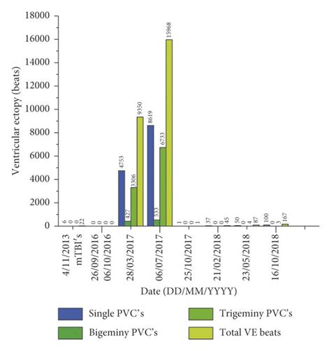 Premature Ventricular Contraction Trigeminy