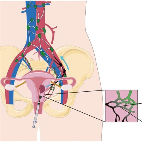 diagram of tracer reaching lymphatic network deep injection into the