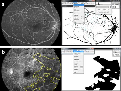 Measurement Of The Number Of Microaneurysms A And Non Perfusion Area Download Scientific