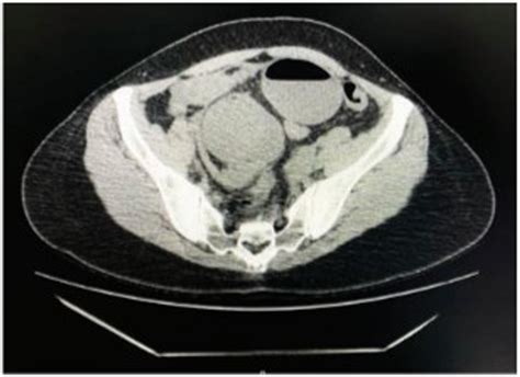 Transient Intussusception Of Terminal Ileum Due To Intestinal