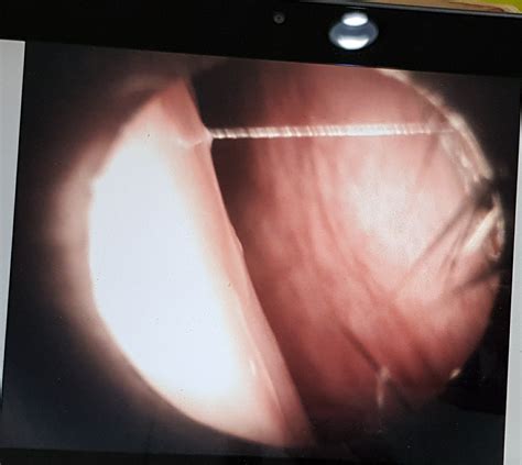 ปากแตก รอบริมฝีปากอักเสบ หรือ ภาวะ Chielitis กับ โรคภูมิแพ้เรื้อรังทางจมูก 1 พบบ่อยมากๆในคนไข้