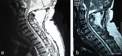 Motor Cortex Stimulation In The Interhemispheric Subdural Space As Treatment For Neuropathic