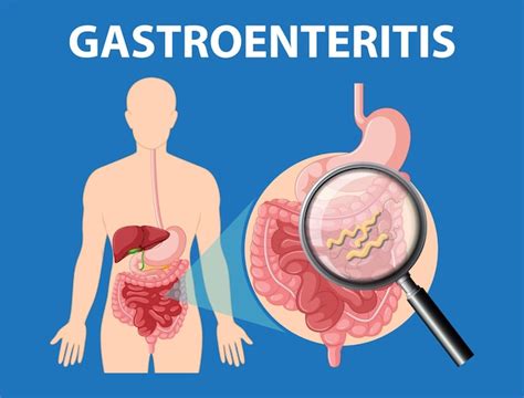 Gastroenteritis Vectors And Illustrations For Free Download Freepik