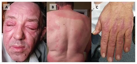 Myositis Skin Rash