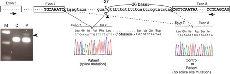 a detection of minor transcript using a new 3 splice site in the