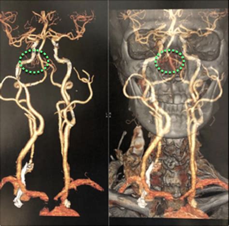 Cervicofacial Angiotomography Doted Area Hypervascular Lesion