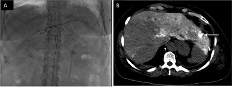 A Angiogram Image Showing Selective Embolization Of The Left Hepatic Download Scientific