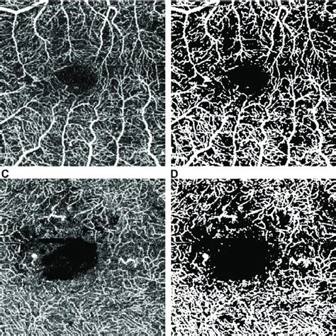 Vessel Density In Swept Source Oct Angiography A Superficial Retinal Download Scientific