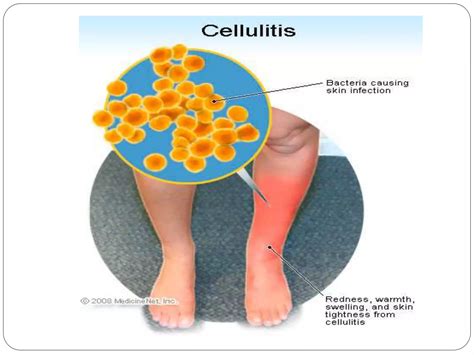 Cellulitis Pptx