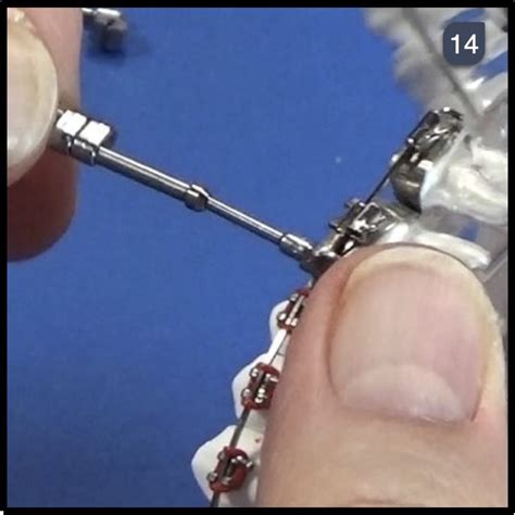 Orthodontic Demonstration Twin Force Bite Corrector Williams Gp