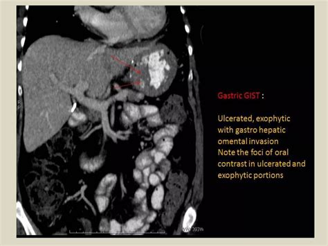 Presentation1 Radiological Imaging Of Gastro Intestinal Stromal Tumour Gist Pptx