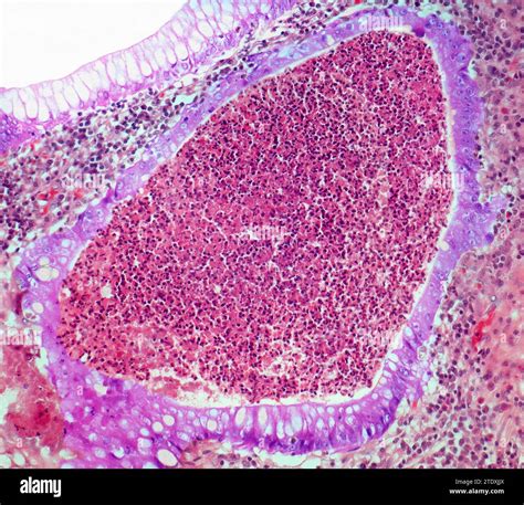 Ulcerative Colitis Light Micrograph Lm Of A Section Through An Affected Tissue Ulcerative