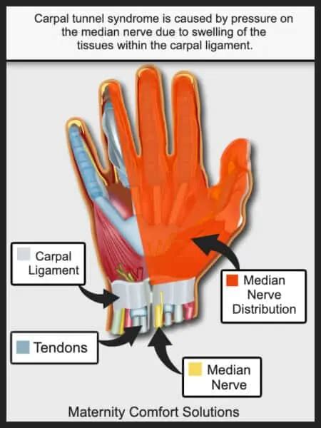Learn How To Relieve Carpal Tunnel Syndrome During Pregnancy
